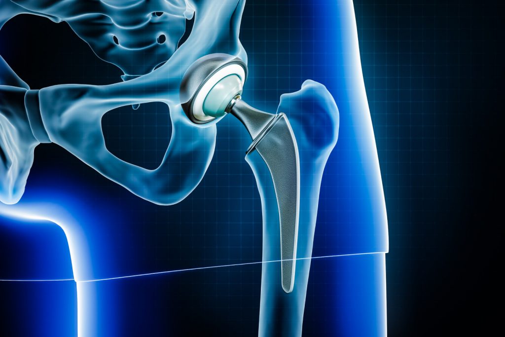 Hip Replacment In Mandala